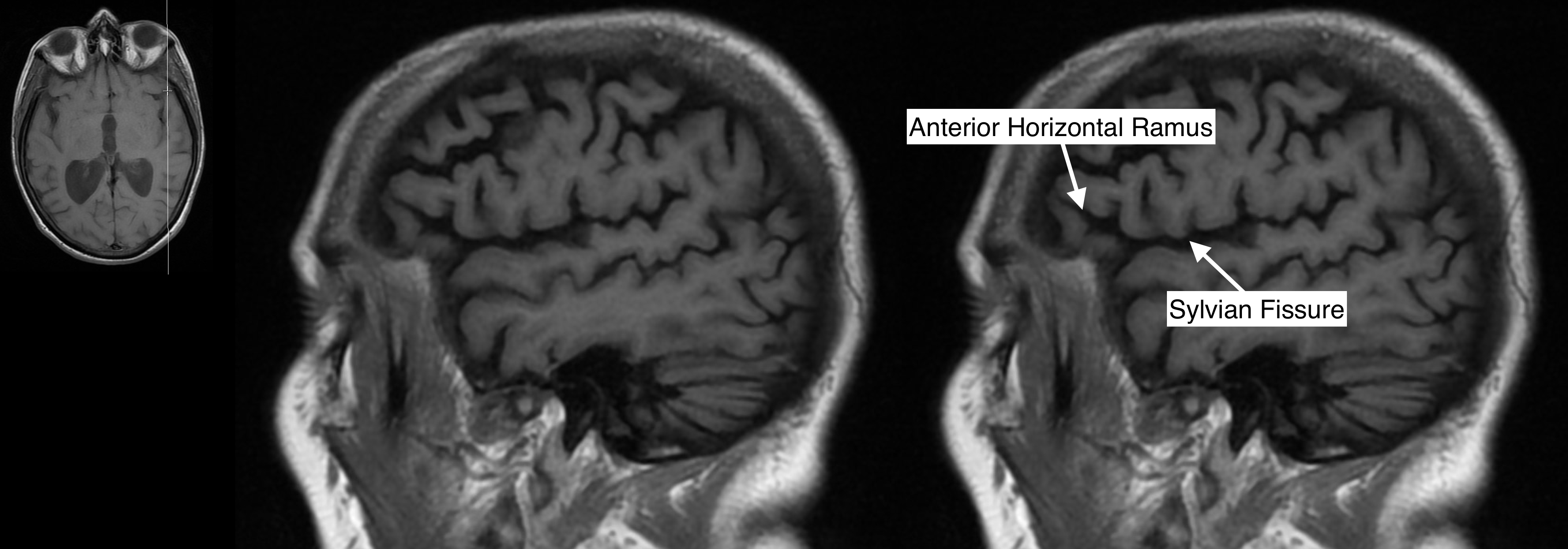 Radiological Anatomy: Anterior Horizontal Ramus Of The Sylvian Fissure ...