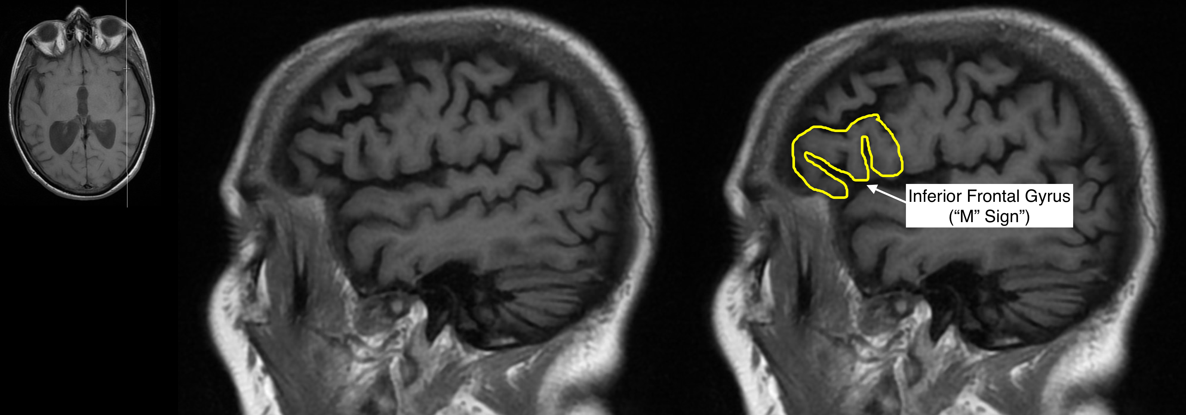 Radiological Anatomy: Inferior Frontal Gyrus - Stepwards