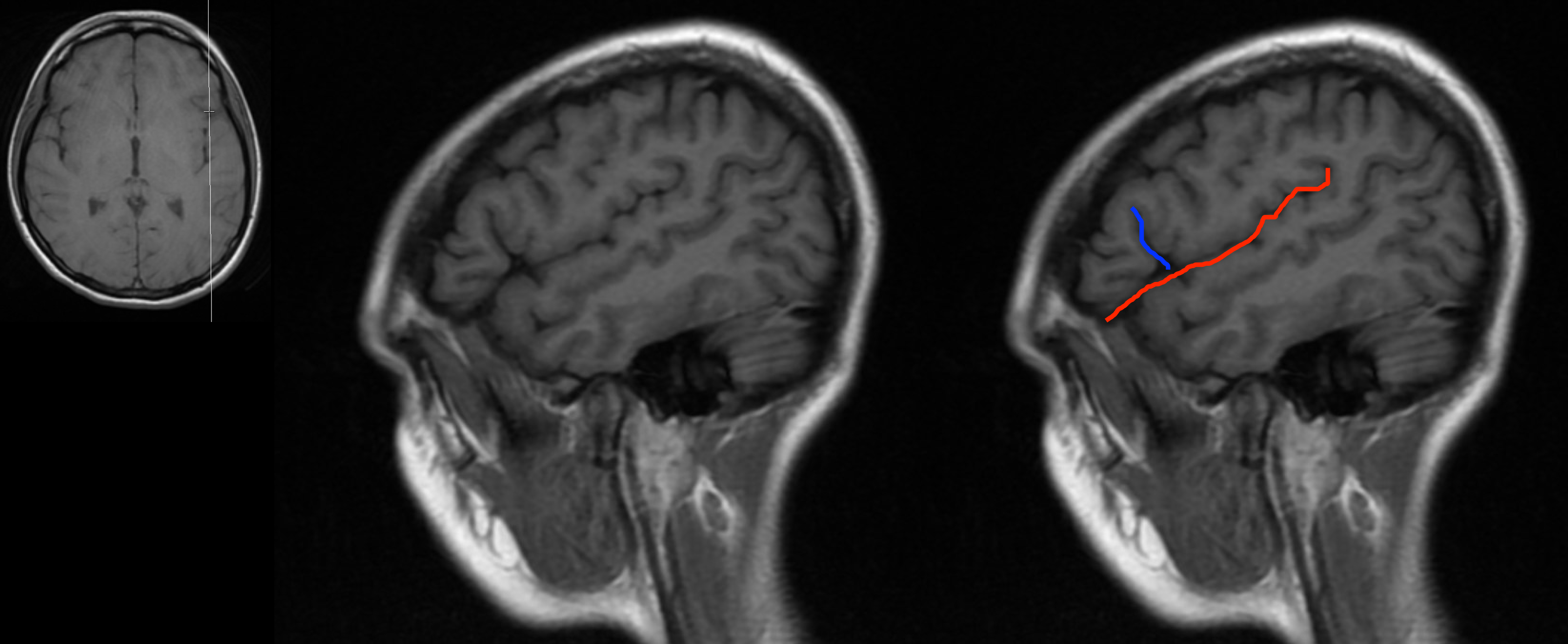 Radiological Anatomy: Anterior Ascending Ramus Of The Sylvian Fissure ...