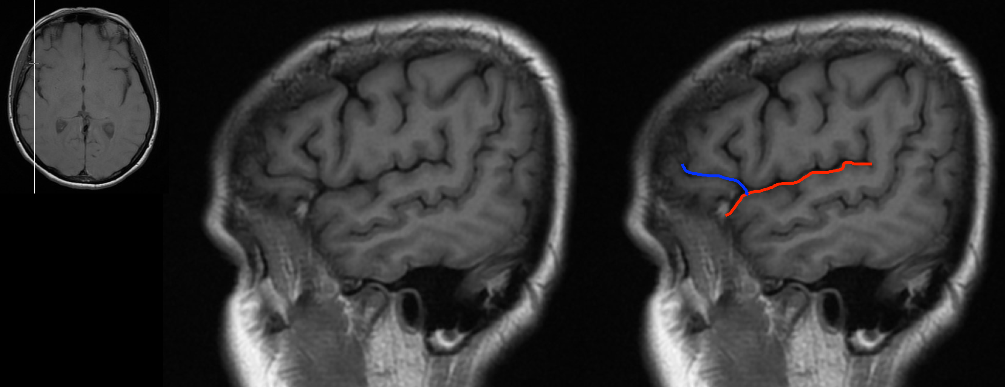 Radiological Anatomy: Anterior Horizontal Ramus Of The Sylvian Fissure ...