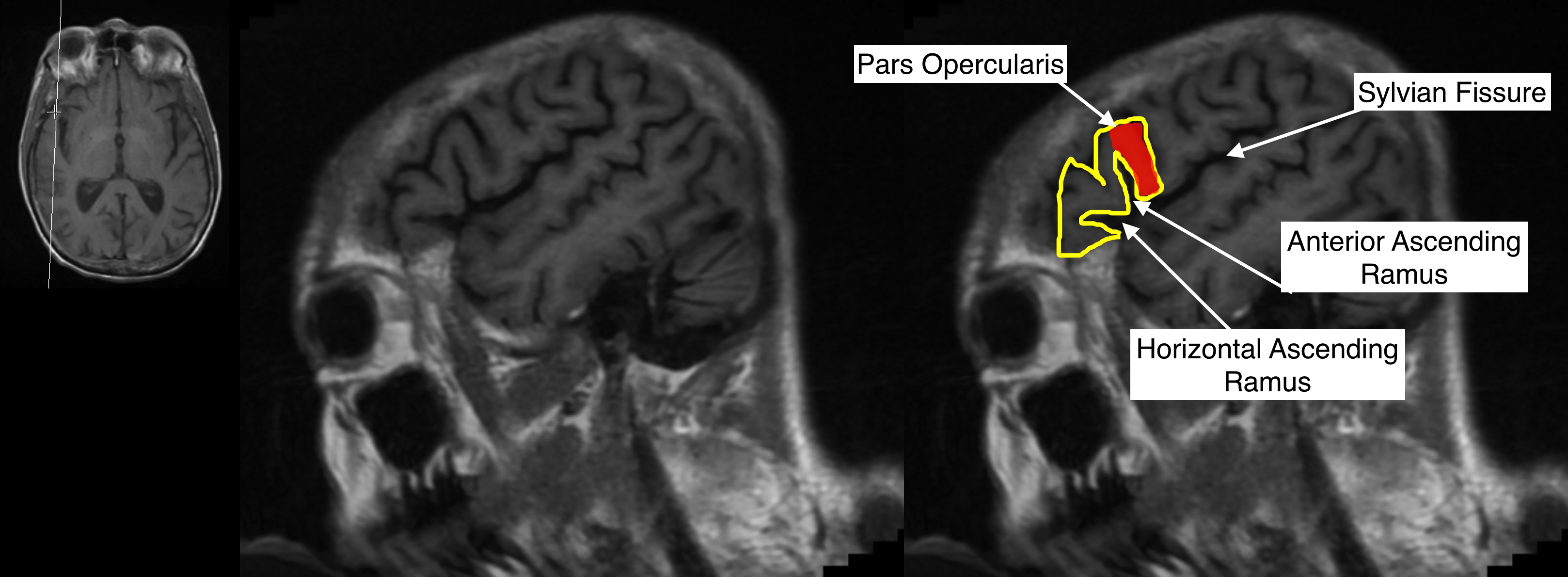 Radiological Anatomy: Pars Opercularis - Stepwards