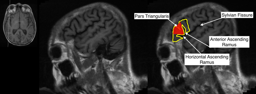 Radiological Anatomy: Pars Triangularis - Stepwards