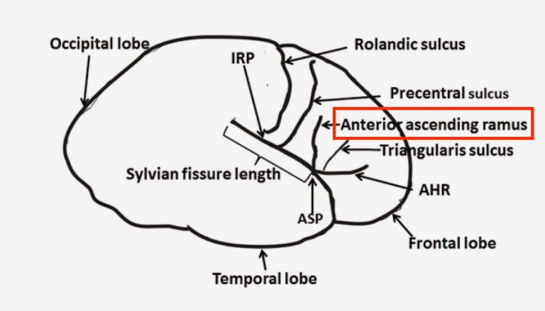Radiological Anatomy: Anterior Ascending Ramus Of The Sylvian Fissure ...