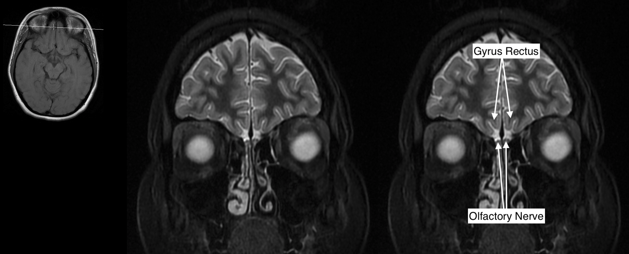 Radiological Anatomy: Gyrus Rectus - Stepwards