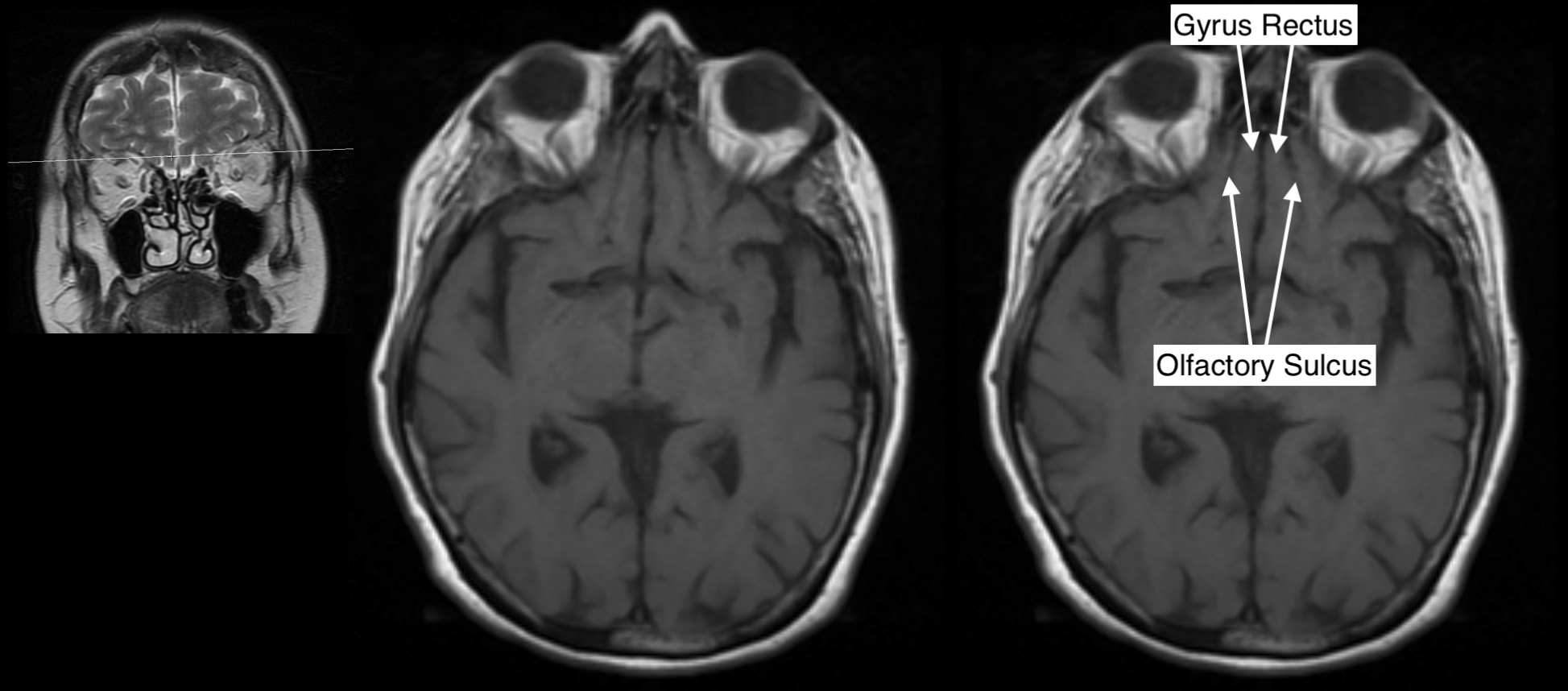 Radiological Anatomy: Gyrus Rectus - Stepwards