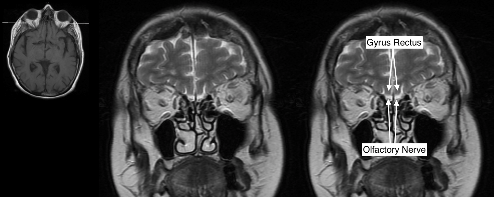 Radiological Anatomy: Gyrus Rectus - Stepwards