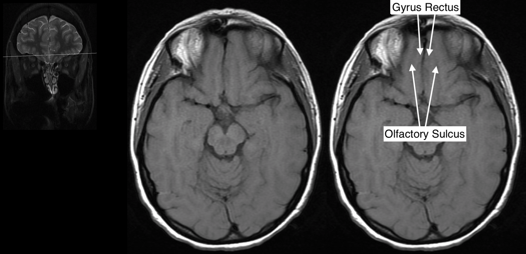 Radiological Anatomy: Gyrus Rectus - Stepwards