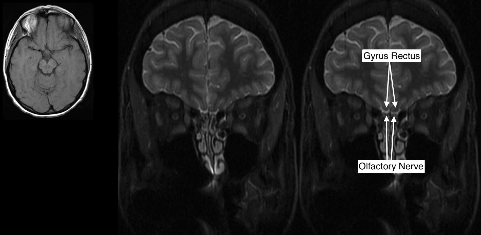 Radiological Anatomy: Gyrus Rectus - Stepwards