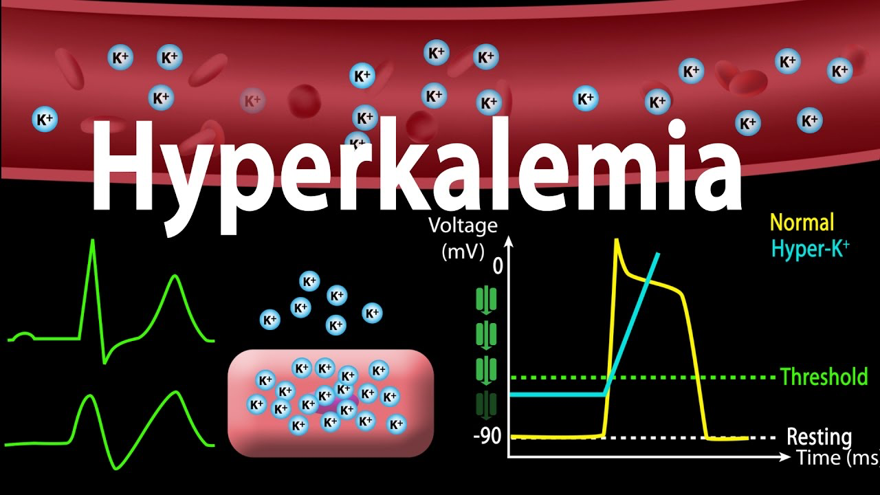 How To Manage Common Medical Problems: Hyperkalemia - Stepwards