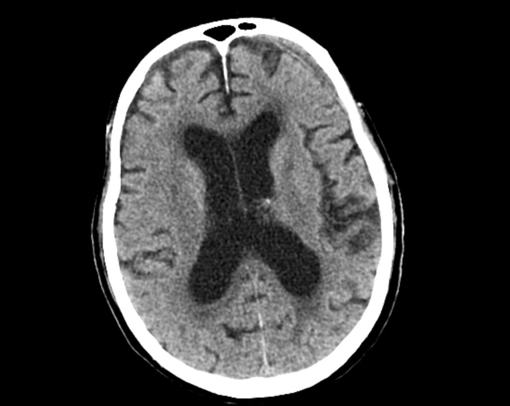 Fundamentals Of Computed Tomography Studies: Windowing - Stepwards