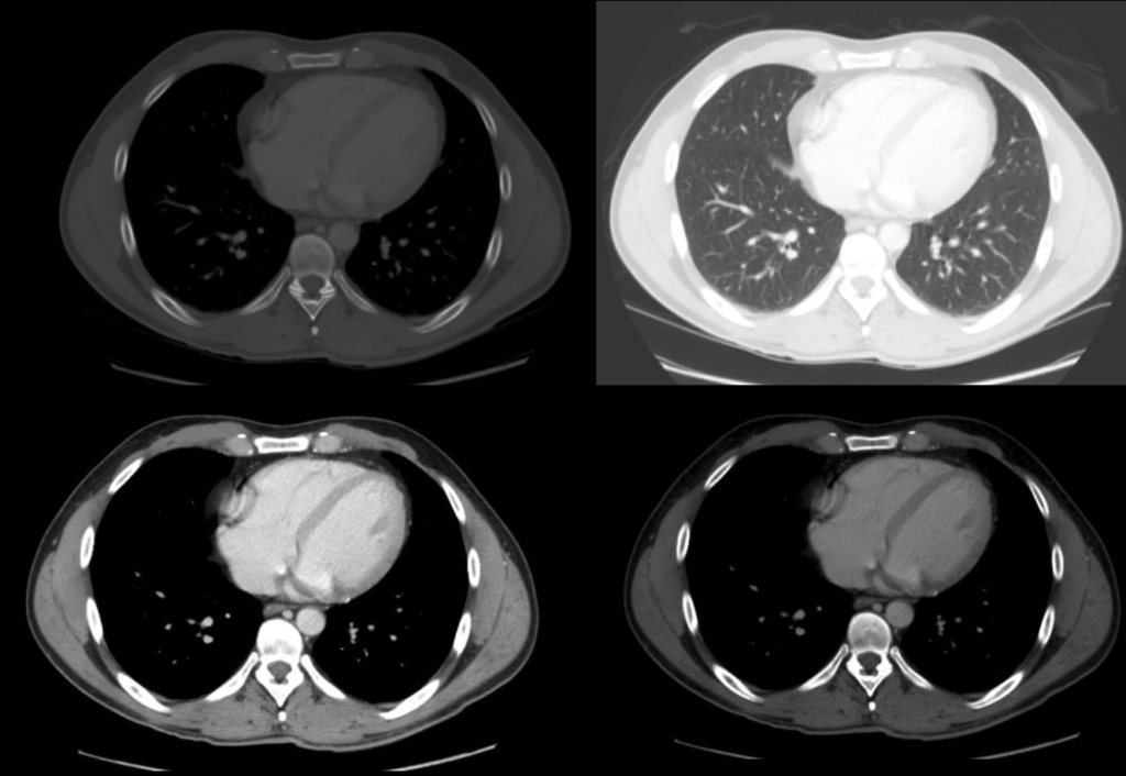 Fundamentals Of Computed Tomography Studies: Windowing - Stepwards
