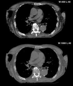 Fundamentals Of Computed Tomography Studies: Windowing - Stepwards