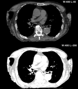 Fundamentals Of Computed Tomography Studies: Windowing - Stepwards