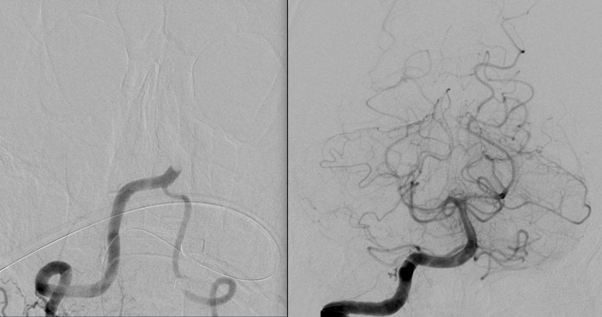 Primer For New Trainees In Neurointerventional Radiology - Stepwards