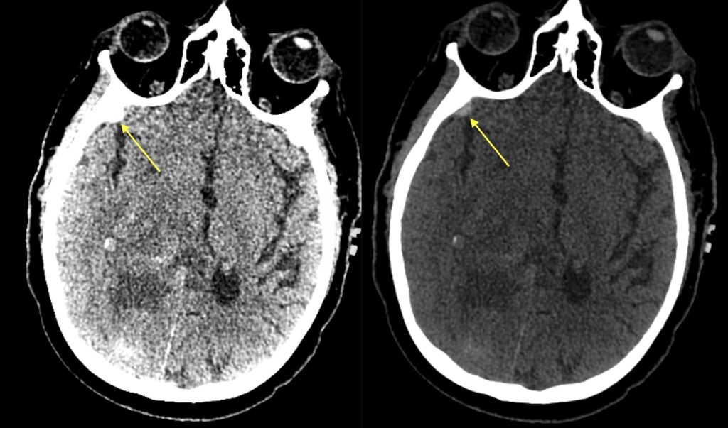 Neuroradiology Call Prep Cases: A c u t e S u b d u r a l H e m a t o m ...