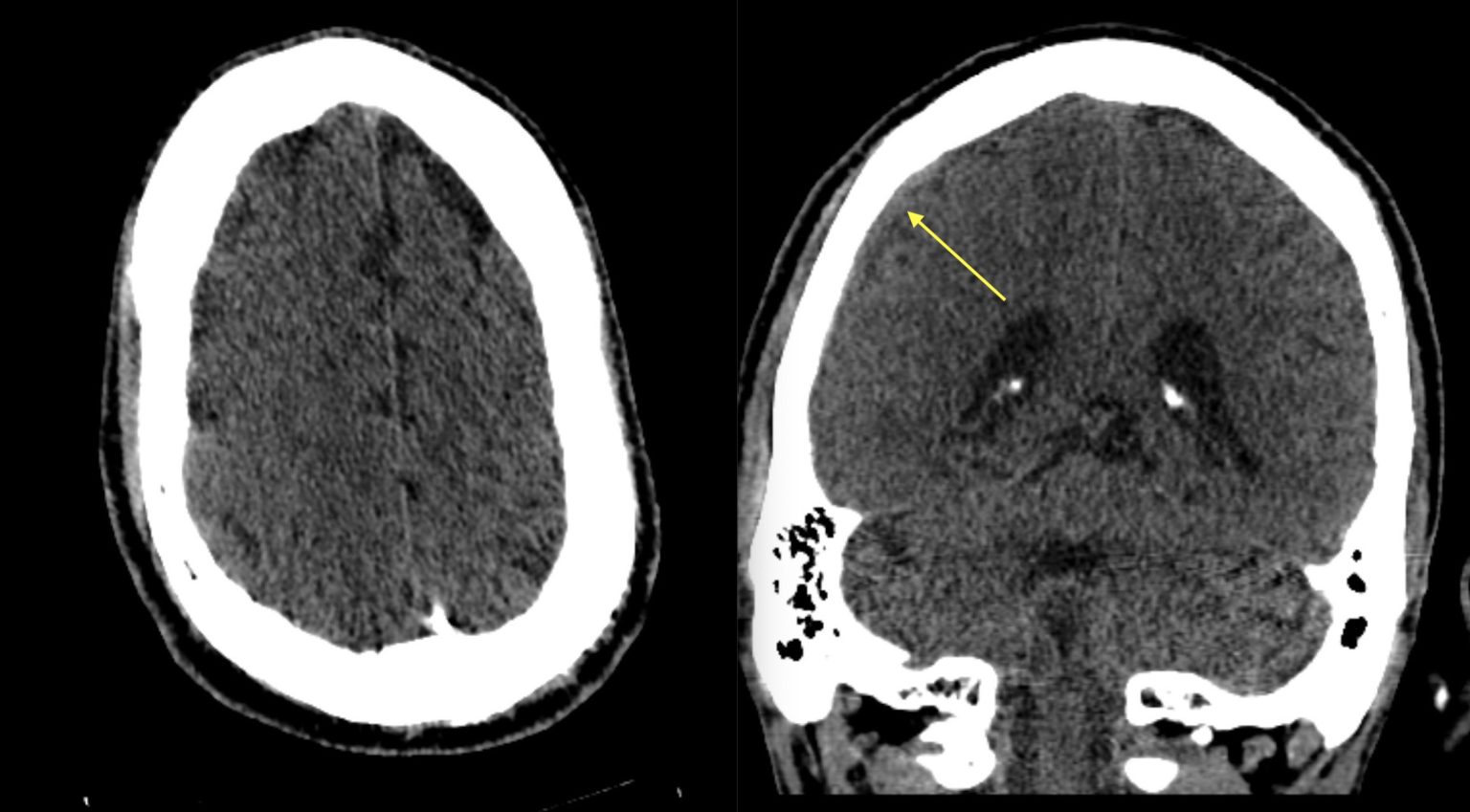 Neuroradiology Call Prep Cases: A c u t e S u b d u r a l H e m a t o m ...