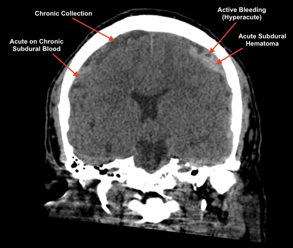 Neuroradiology Call Prep Cases: A c u t e S u b d u r a l H e m a t o m ...
