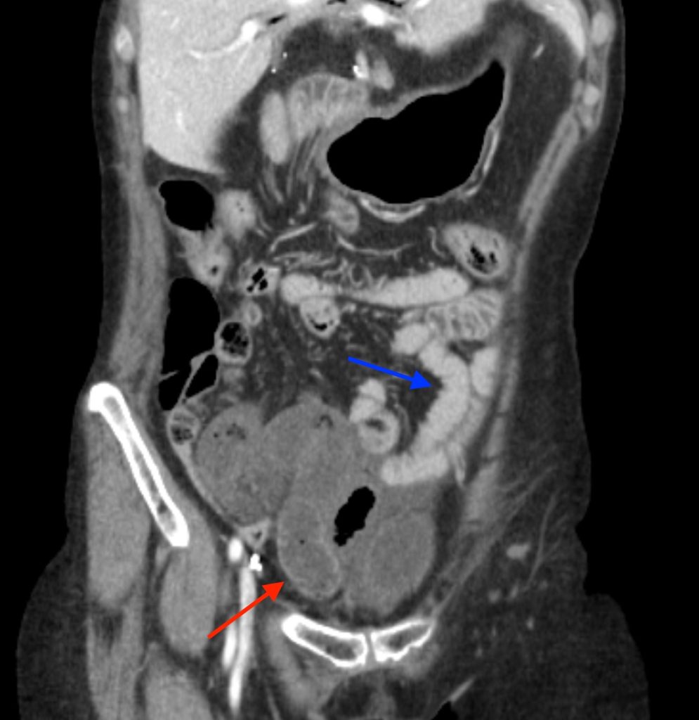 Abdominal Imaging Call Prep Cases: C l o s e d L o o p S m a l l B o w ...