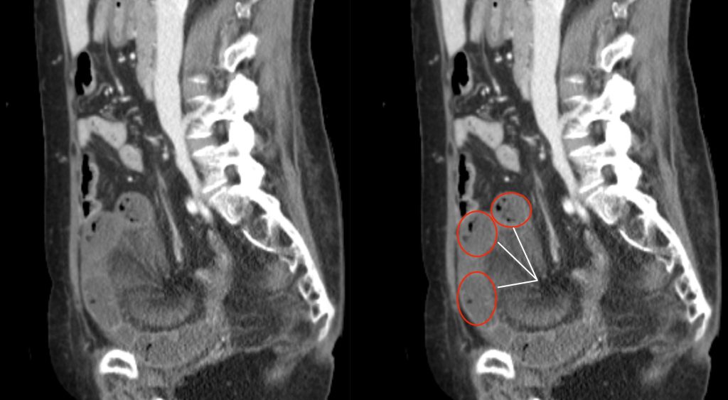Abdominal Imaging Call Prep Cases: C l o s e d L o o p S m a l l B o w ...
