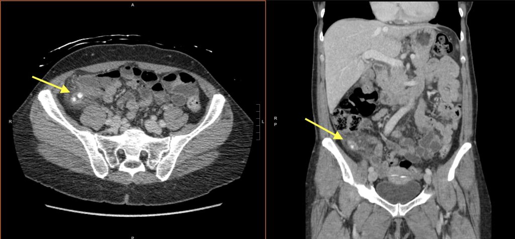 Abdominal Imaging Call Prep Cases: Acute Uncomplicated Appendicitis (CT ...