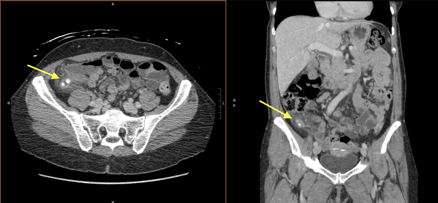 Abdominal Imaging Call Prep Cases: Acute Uncomplicated Appendicitis (CT ...