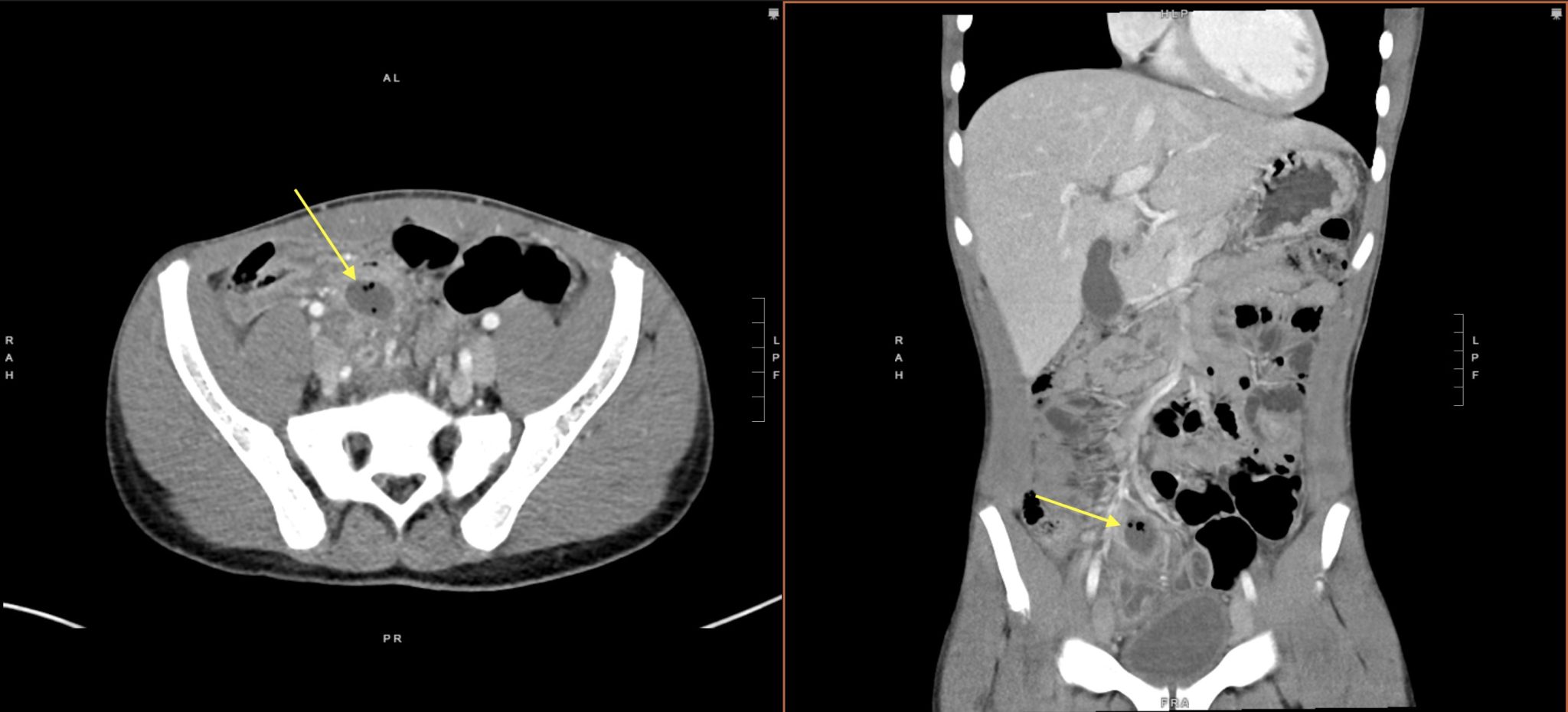 Abdominal Imaging Call Prep Cases: A p p e n d i c i t i s C o m p l i ...