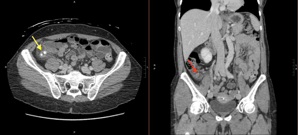 Abdominal Imaging Call Prep Cases: Acute Uncomplicated Appendicitis (CT ...