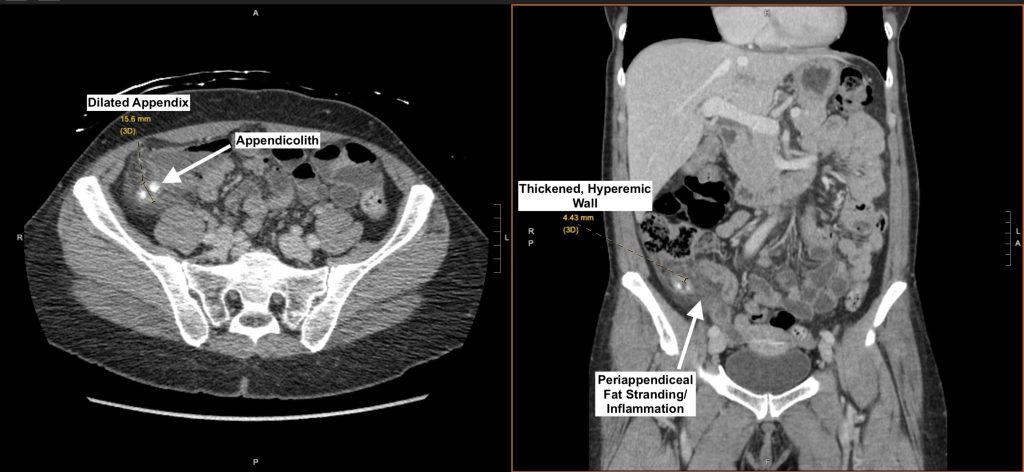 Abdominal Imaging Call Prep Cases: Acute Uncomplicated Appendicitis (CT ...