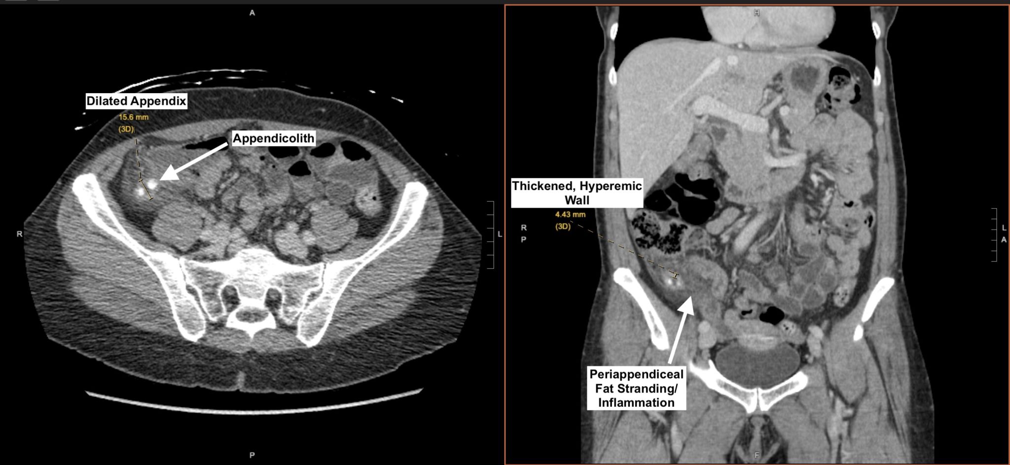 Abdominal Imaging Call Prep Cases: Acute Uncomplicated Appendicitis (CT ...