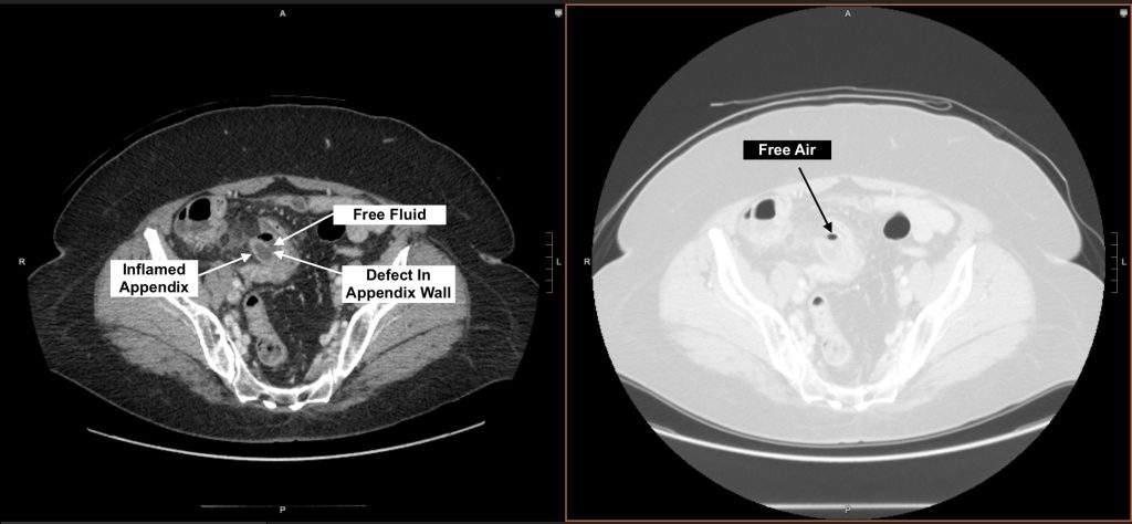 Abdominal Imaging Call Prep Cases: P e r f o r a t e d A p p e n d i c ...
