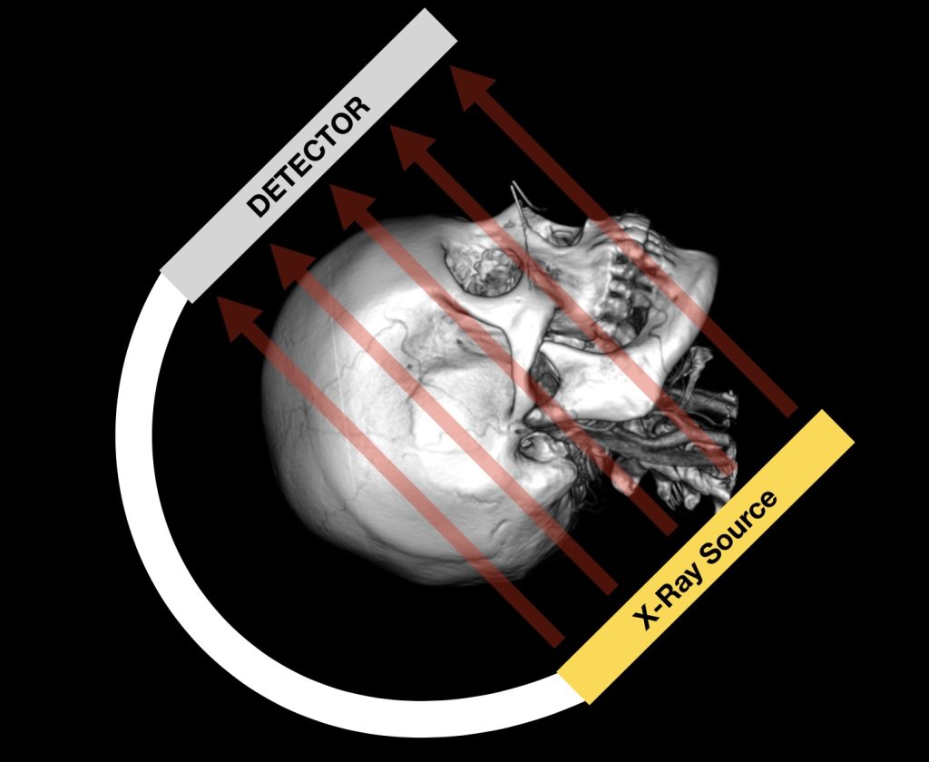 Commonly Utilized Angiographic Projections In Neurointerventional ...