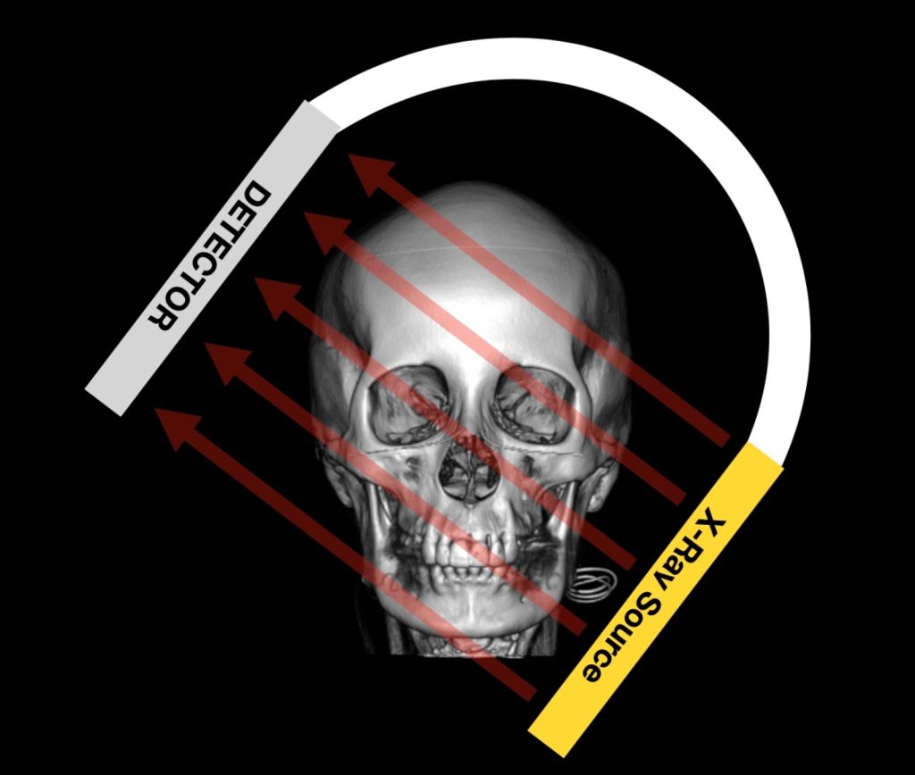 Commonly Utilized Angiographic Projections In Neurointerventional ...