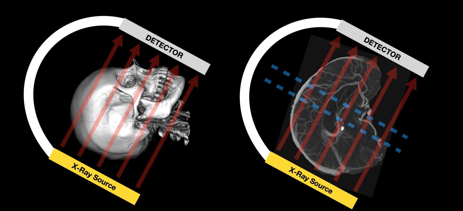 Commonly Utilized Angiographic Projections In Neurointerventional ...