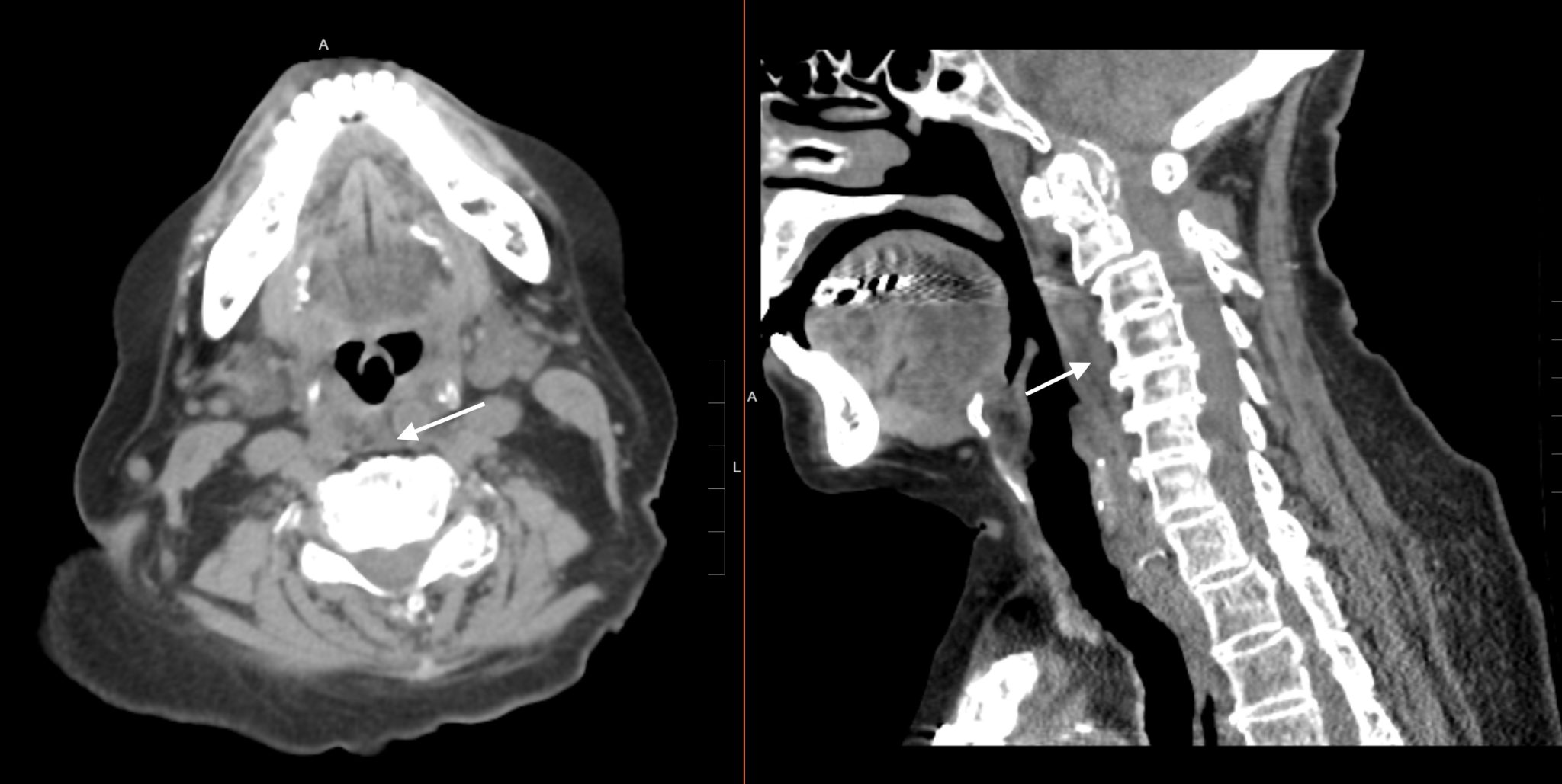 Neuroradiology Call Prep Cases: Cervical Prevertebral Edema (CT ...