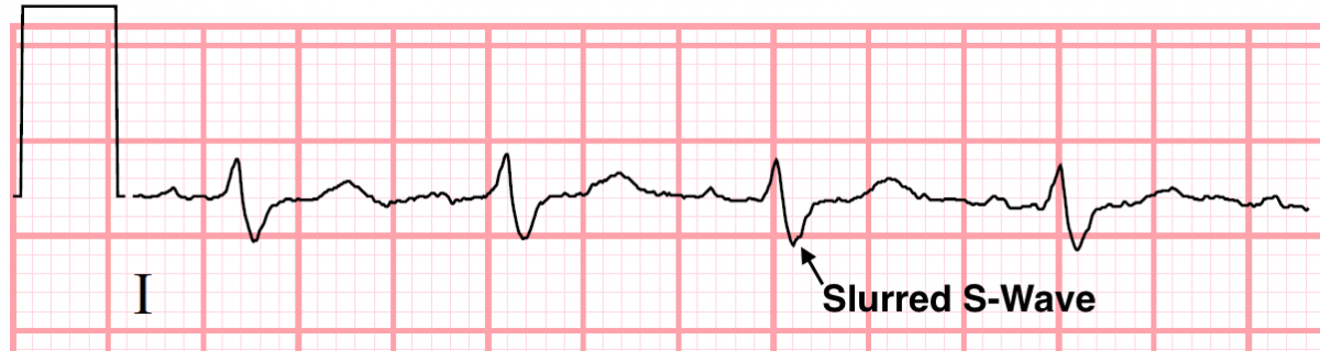 Condition Specific EKGs: Right Bundle Branch Block (RBBB) - Stepwards