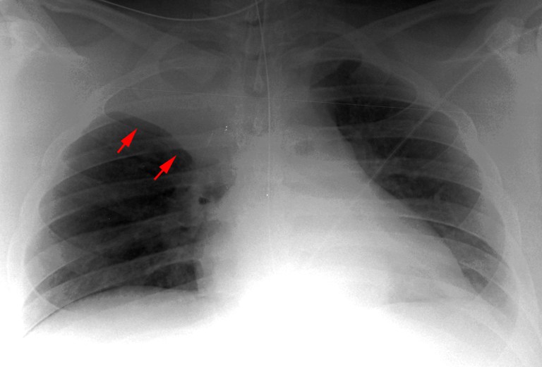 Condition Specific Radiology: Atelectasis – Stepwards